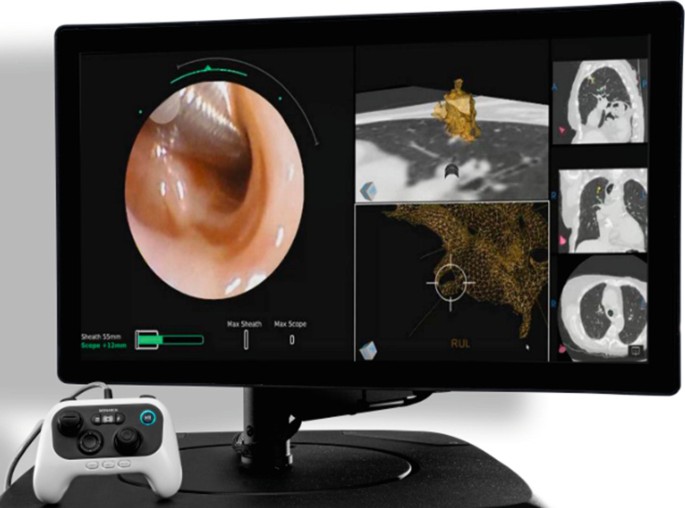 Navigational Bronchoscopy | SpringerLink