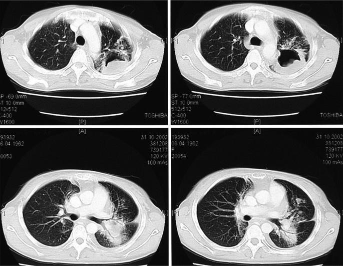 Endoscopic Lung Abscess Drainage | Springer Nature Link