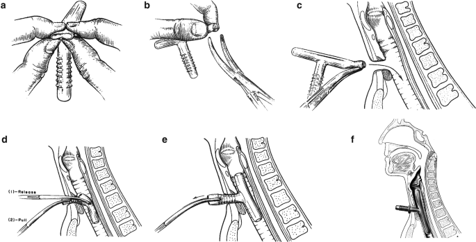 Montgomery T-Tubes | Springer Nature Link