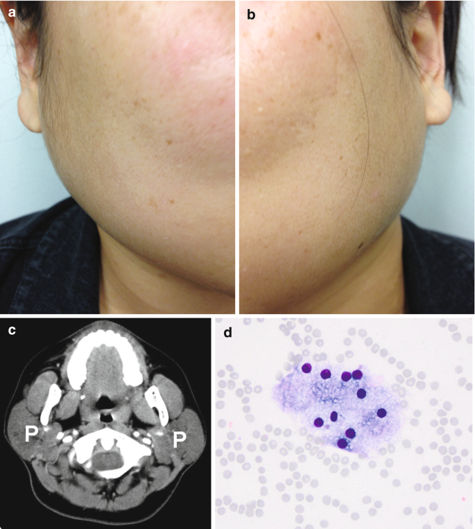 Endocrinopathies and the Salivary Glands | SpringerLink