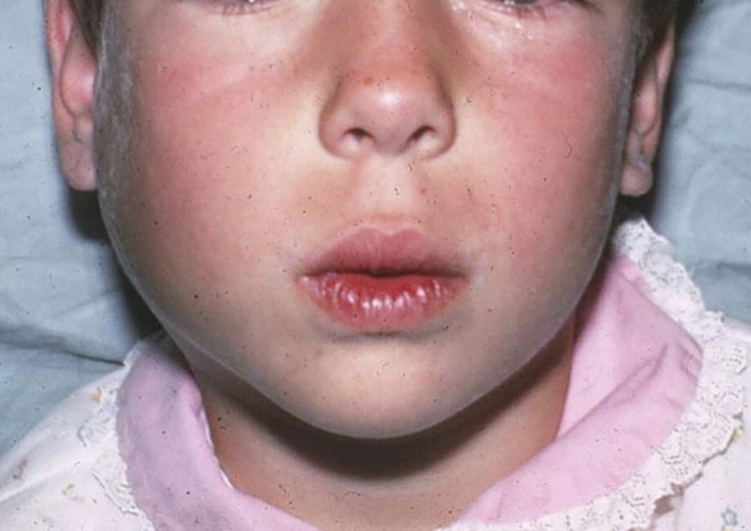Salivary Gland Disease in Children | SpringerLink