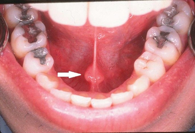 Iatrogenic Duct Injury | SpringerLink