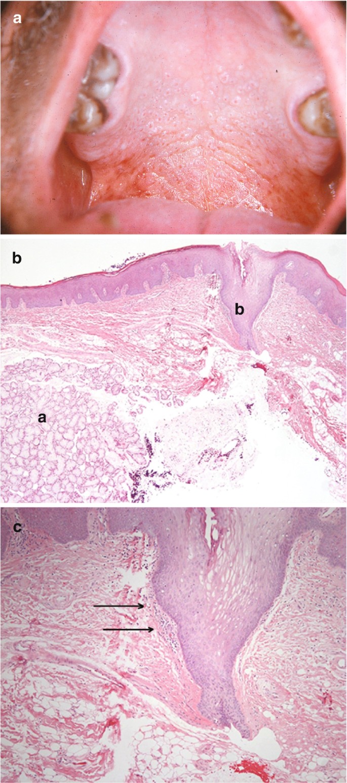 Minor Salivary Glands | SpringerLink