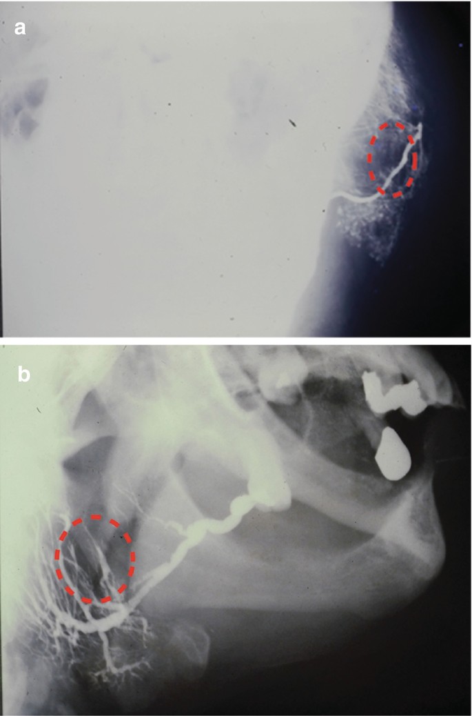 Benign Salivary Gland Neoplasms | SpringerLink