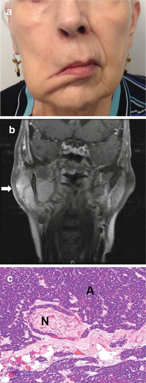 Malignant Salivary Gland Neoplasms | Springer Nature Link