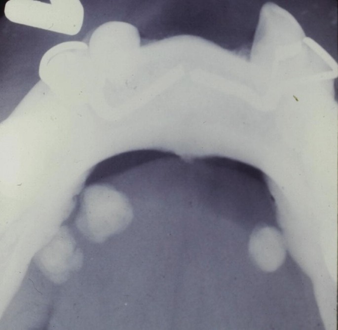 Sialolithiasis | SpringerLink