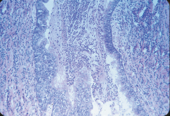 Parotid Infection | SpringerLink