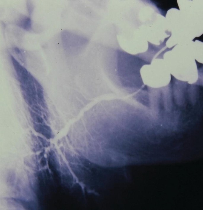 Parotid Infection | Springer Nature Link (formally SpringerLink)