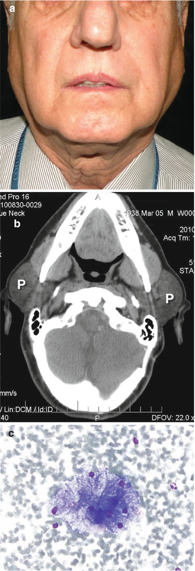 Sialadenosis | SpringerLink