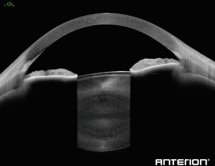 ANTERION Swept-Source OCT Biometer | SpringerLink