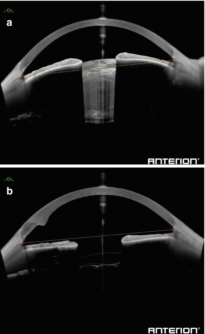 ANTERION Swept-Source OCT Biometer | SpringerLink