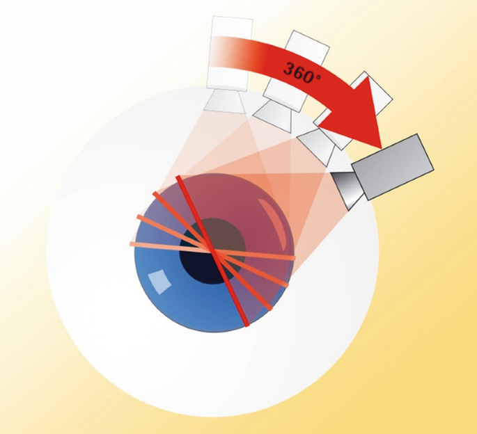 The Pentacam Family | SpringerLink