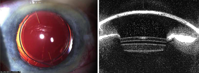 Calculation of Phakic and Pseudophakic Additional Lenses | SpringerLink