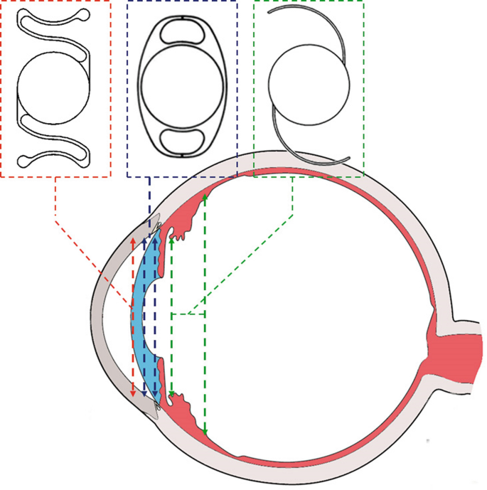 Out-of-the-Bag Implantation IOL Power | SpringerLink