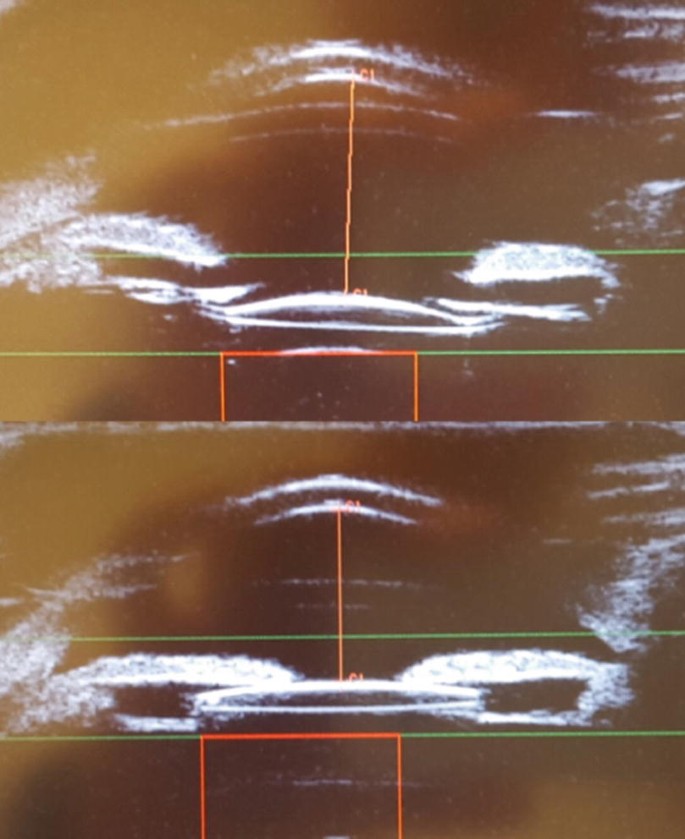 Out-of-the-Bag Implantation IOL Power | SpringerLink