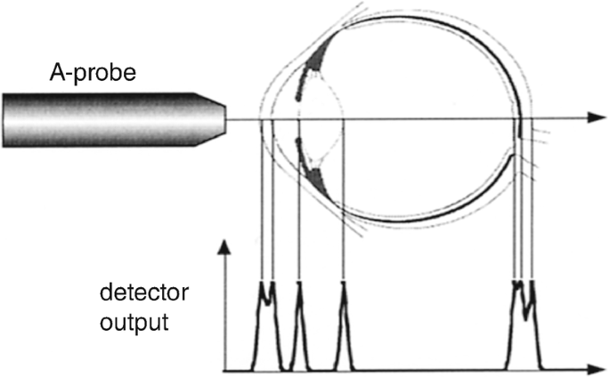 Ultrasound Biometry | SpringerLink