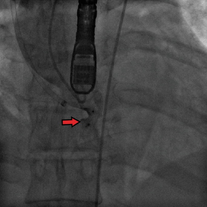 Transcatheter Closure of Ruptured Sinus of Valsalva | SpringerLink