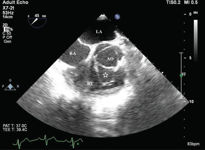 Transcatheter Closure of Ruptured Sinus of Valsalva | SpringerLink