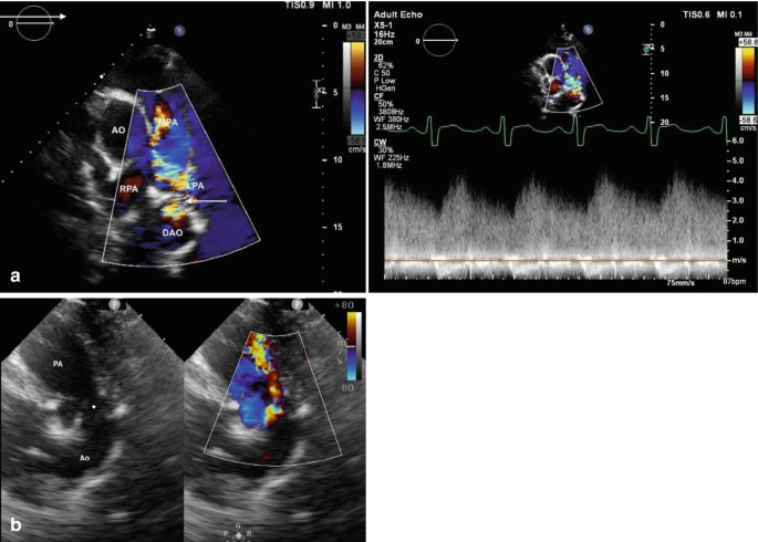 Percutaneous Closure of Patent Ductus Arteriosus | SpringerLink