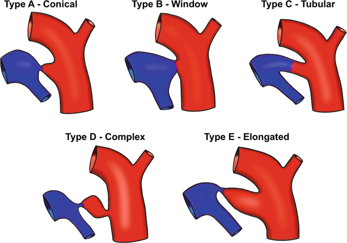 Percutaneous Closure of Patent Ductus Arteriosus | SpringerLink