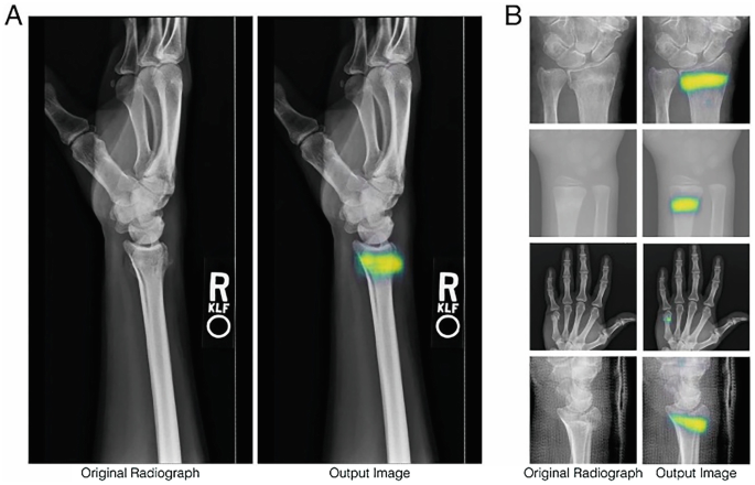 Machine Learning-Based Classification of X-Ray Images Using ...