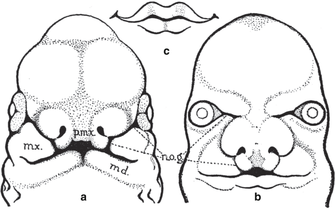 Nose Reconstruction Through Nasal Frame Distraction in Frontonasal ...