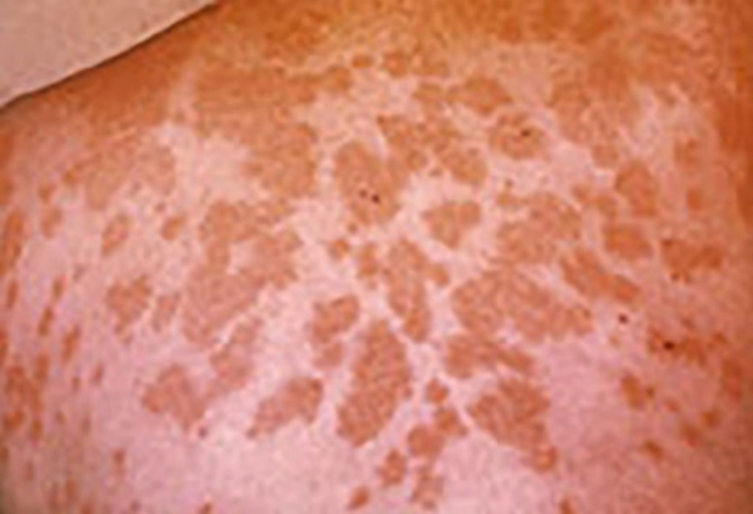 Fungal Diseases | SpringerLink