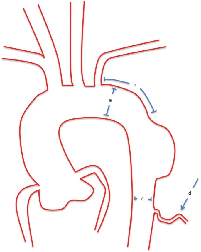 Reporting Checklist: Endovascular Pre-Treatment | SpringerLink