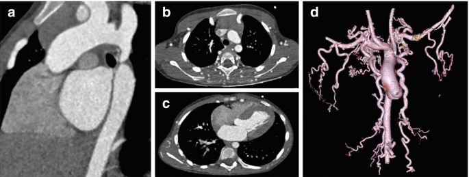 Congenital Obstructive Heart Disease | SpringerLink
