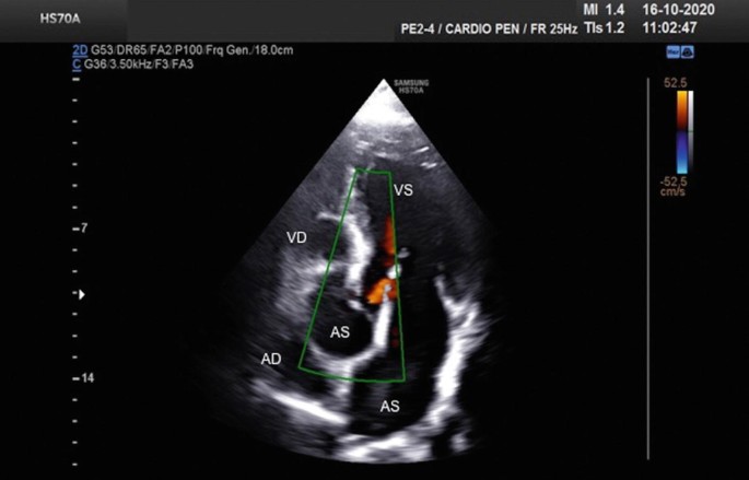 Transthoracic and Transesophageal Echocardiography | SpringerLink