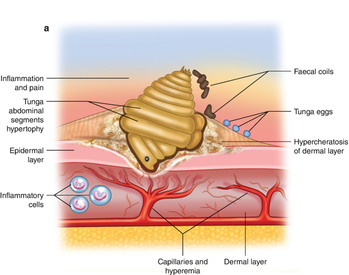 Tungiasis | SpringerLink