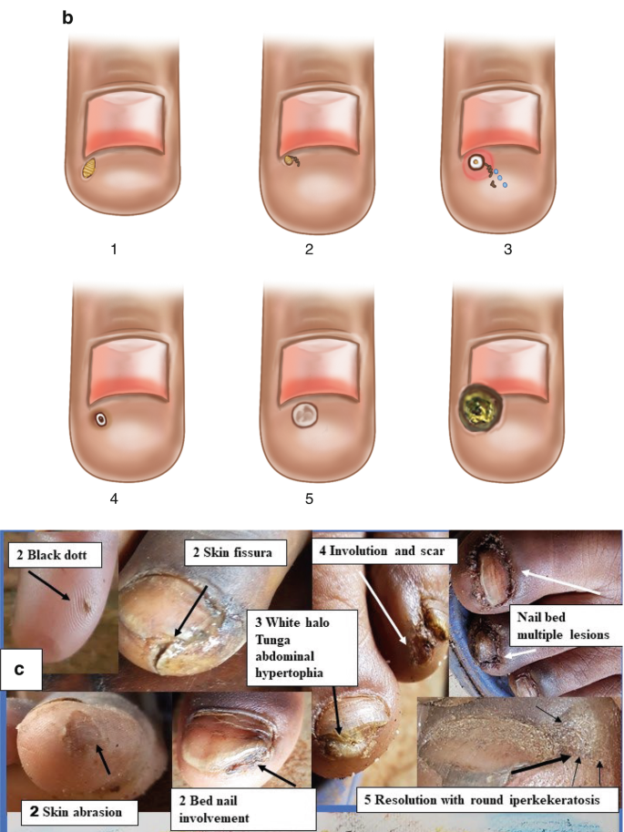 Tungiasis | SpringerLink