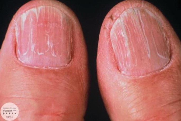Age-Related Nail Changes and Disorders | Springer Nature Link