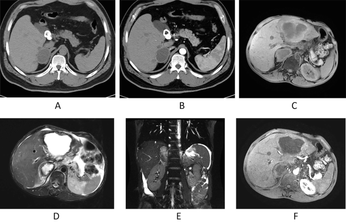 CT and MR Features of Echinococcosis | SpringerLink