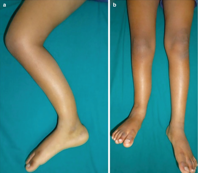 Etiology of Lower Limb Deformity | SpringerLink