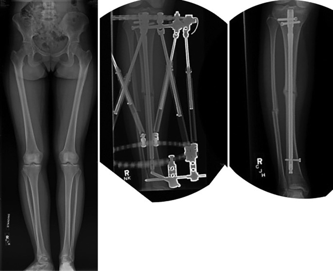 Hybrid Techniques for Limb Length and Deformity Correction | SpringerLink