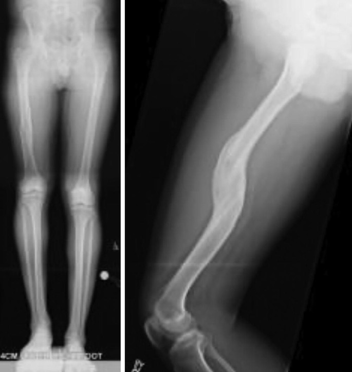 Motorized Intramedullary Lengthening of the Femur: Antegrade and ...