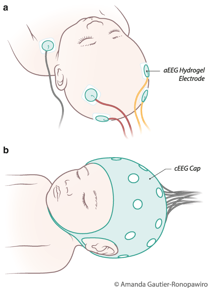 Neurophysiological Monitoring | SpringerLink