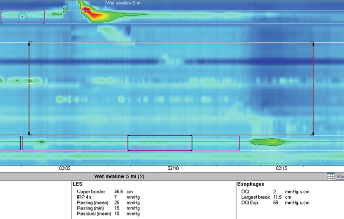 GERD That Would Not Get Better | SpringerLink