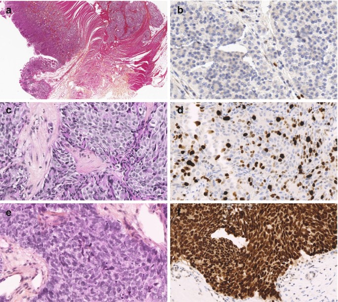 Pathological Evaluation and Classification of Digestive Neuroendocrine ...