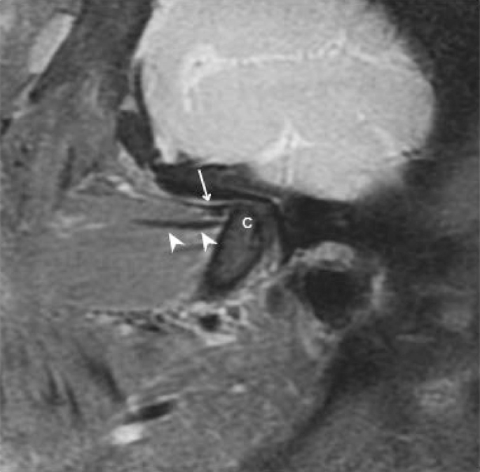 Temporomandibular Joint: Review of the Anatomy, Pathology, and Magnetic ...