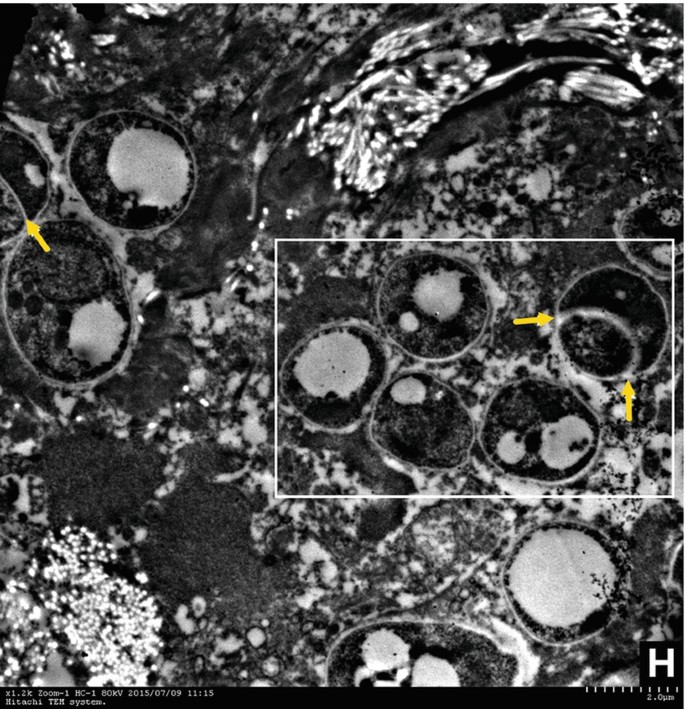 Talaromycosis Caused by Talaromyces marneffei | SpringerLink