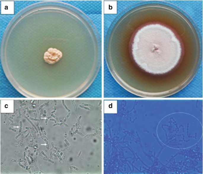 Talaromycosis Caused by Talaromyces marneffei | Springer Nature Link