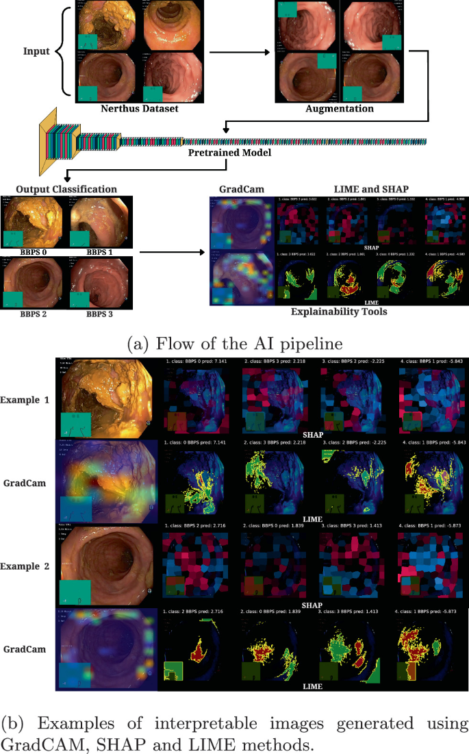 Automated BBPS Scoring in Colonoscopy: A Comparative Analysis of Pre ...