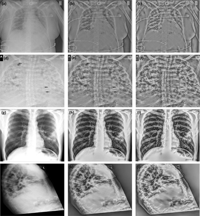 On the Application of Log Compression and Enhanced Denoising in ...