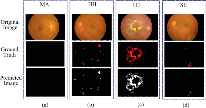 A Lightweight UNet with Inverted Residual Blocks for Diabetic ...