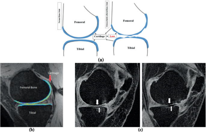 Cartilage Segmentation from MRI Images Towards Prediction of Osteoarthritis | SpringerLink