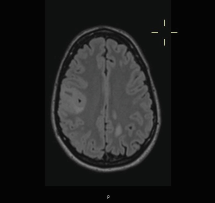 Twitching in the Face and Tingling | SpringerLink