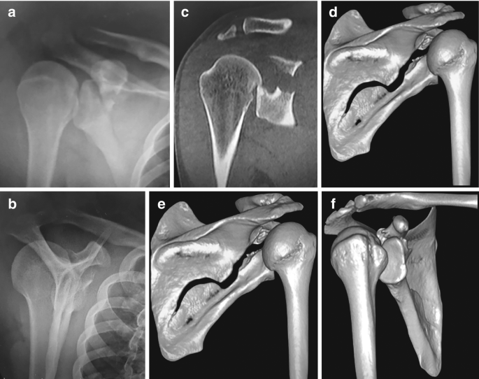 Special Considerations: Complex Scapular Fractures—Preoperative ...