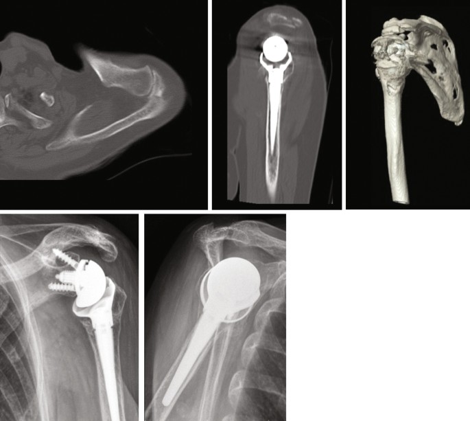 Periprosthetic Scapular Fractures Following Reverse Shoulder ...